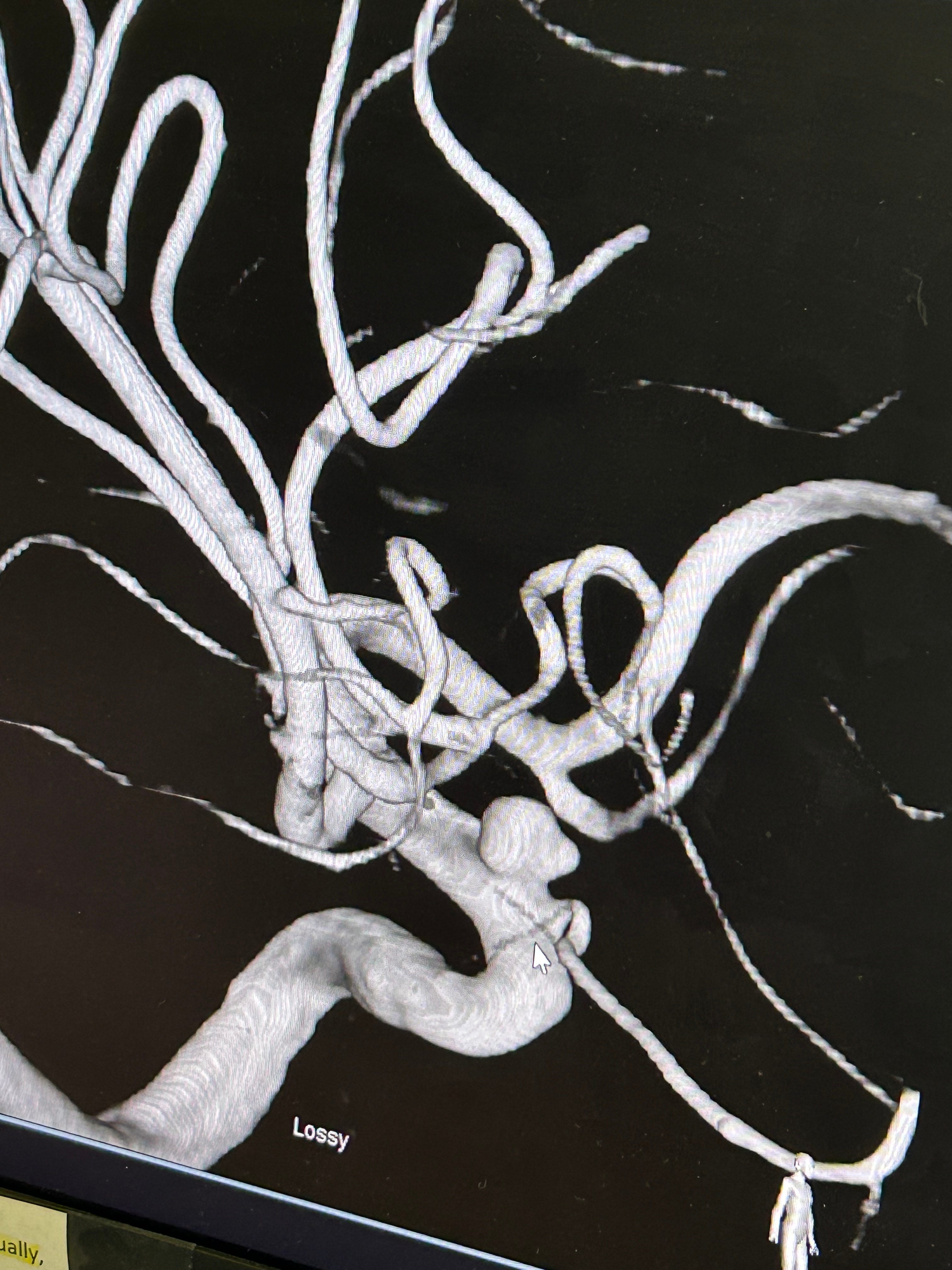 The Impression of a Brain Aneurysm: Part 3