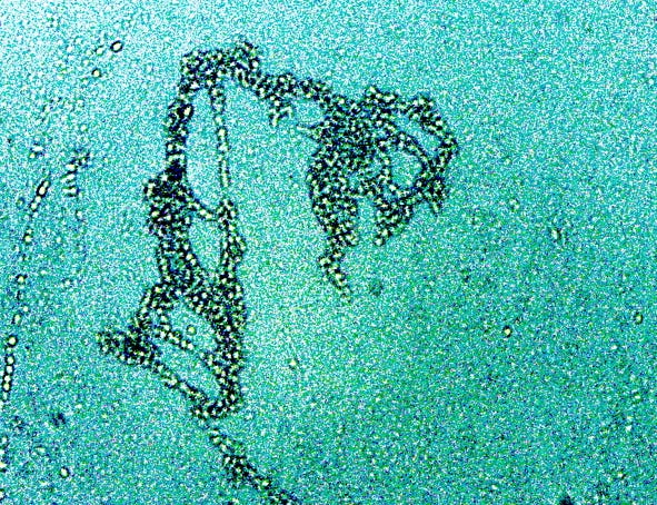 Extensive (CDB) Hydrogel Filament Growth In C19 Vaccinated and ...