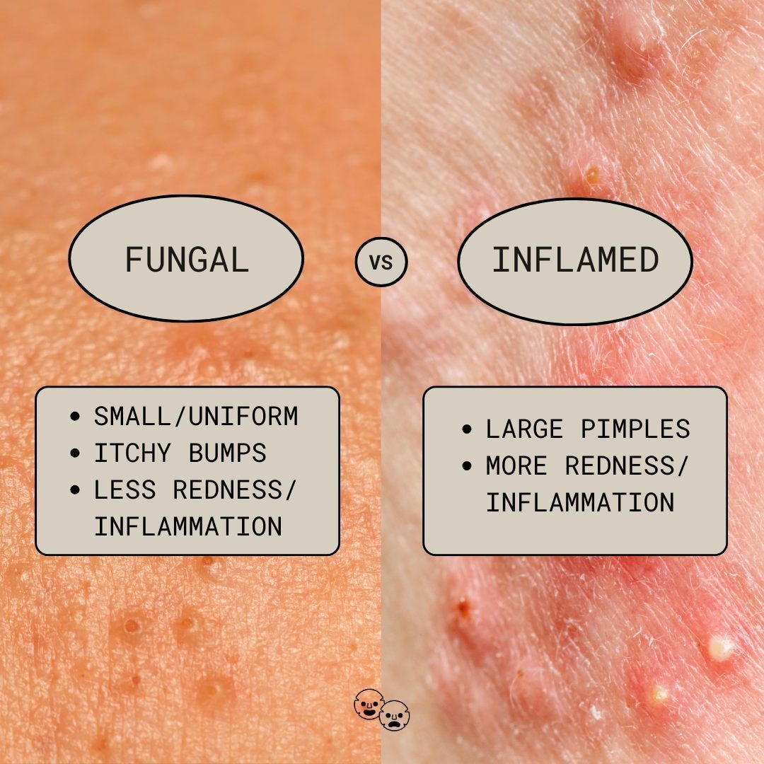 What is "fungal acne" anyway? - by sofie pavitt