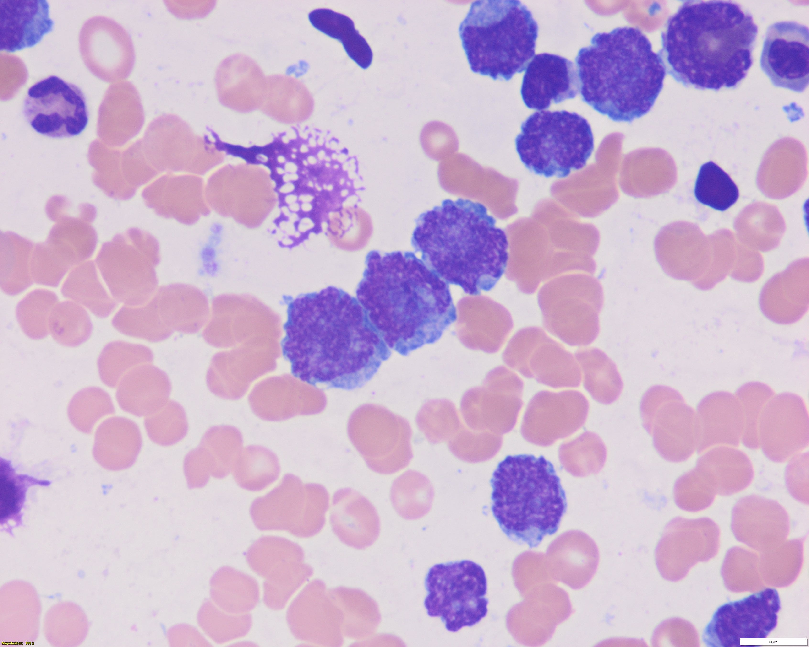Acute myeloid leukemia with NUP98 rearrangement