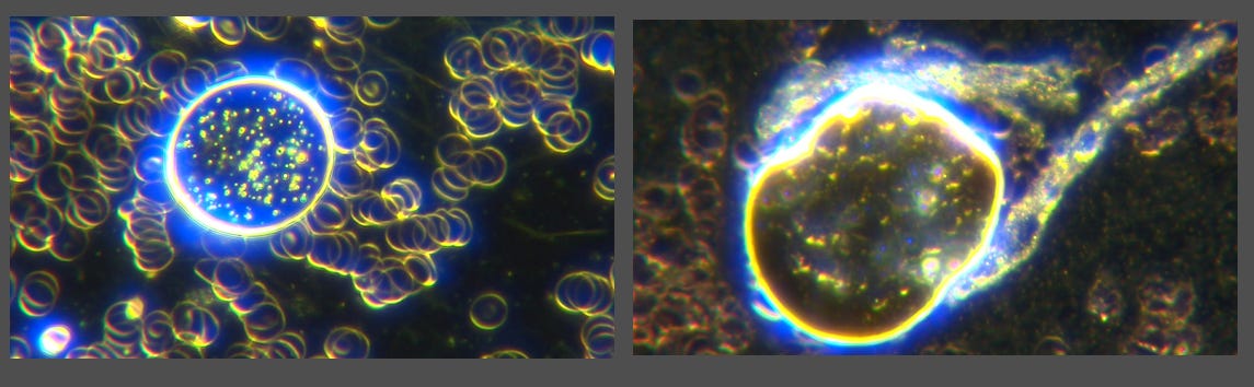 "Vaccine" Microscopy By Dr. Geanina Hagima In Romania: Comirnaty ...