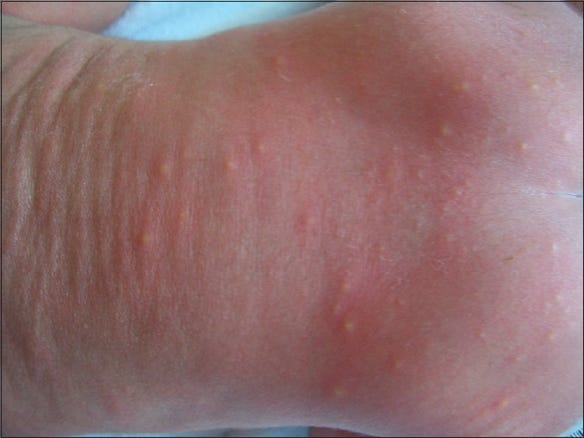 Pediatric Pearls: Infant's Skin Part 2 - My Big 4