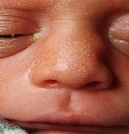 Pediatric Pearls. Infant's Skin: Milia and More