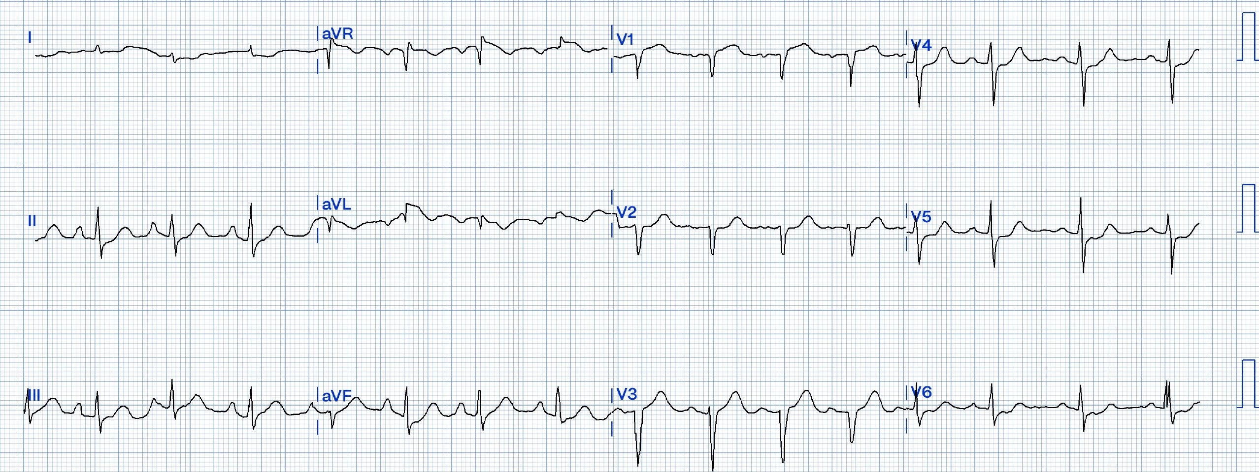 Occlusion Myocardial Infarction [Queen of Hearts Algorithm]