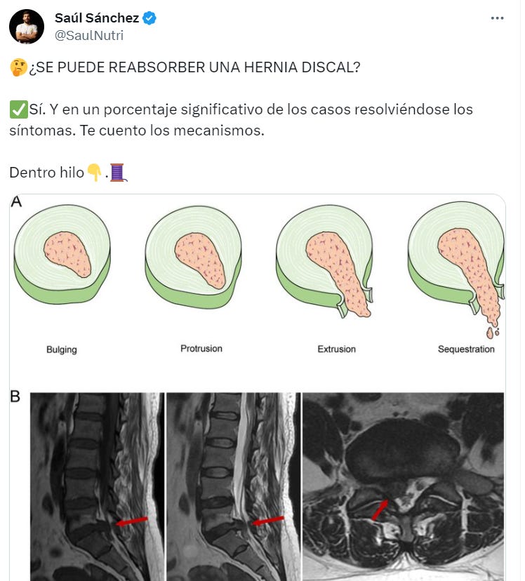 #71 Semana 20/10/2023 - Hernias discales. ¿Se pueden reabsorber? ¿Cómo recuperarse del dolor y ...