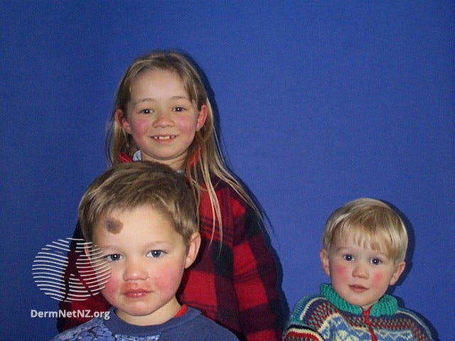 Pediatric Pearls. TORCH Infections: Parvovirus