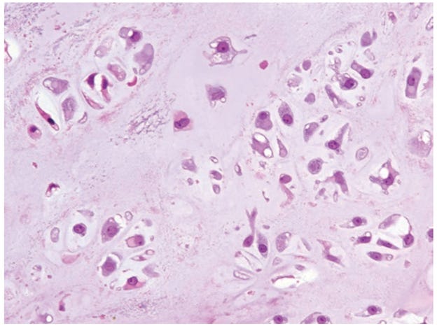 Diagnosis and Treatment of Conventional Chondrosarcoma