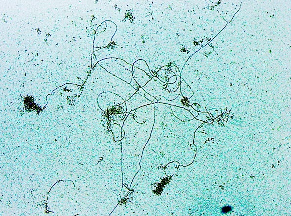 Extensive (CDB) Hydrogel Filament Growth In C19 Vaccinated and ...