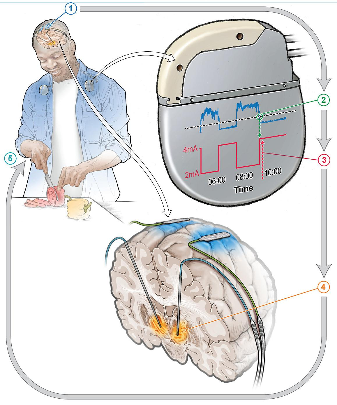 Drug and Device Approvals: Deep Brain Stimulation Therapy for PD ...