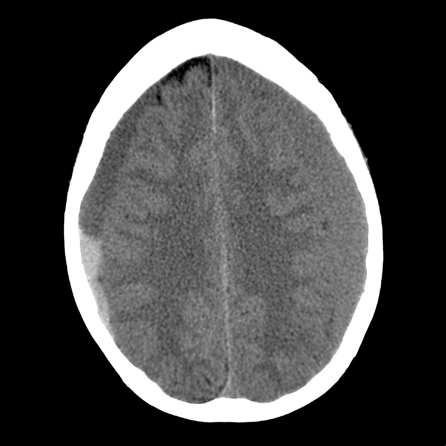Subacute and chronic subdural hematoma