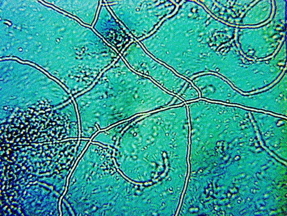 Extensive (CDB) Hydrogel Filament Growth In C19 Vaccinated and ...