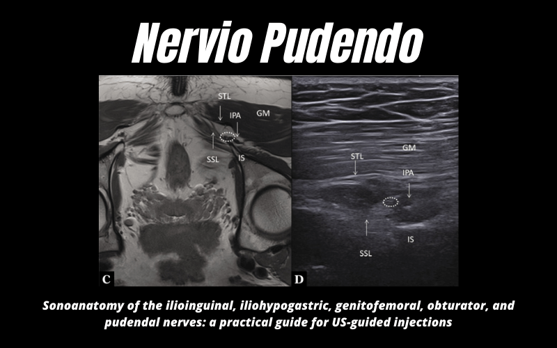 Nervio obturador, pudendo, ilioinguinal, iliohipogástrico y genitofemoral