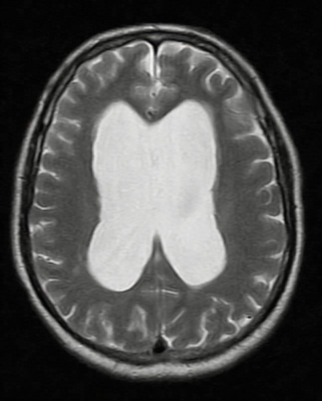 Normal Pressure Hydrocephalus - by Bill Heath