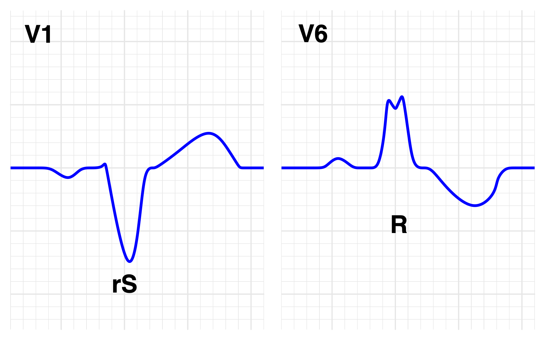 Myocardial Infarction with LBBB: The Sgarbossa Criteria