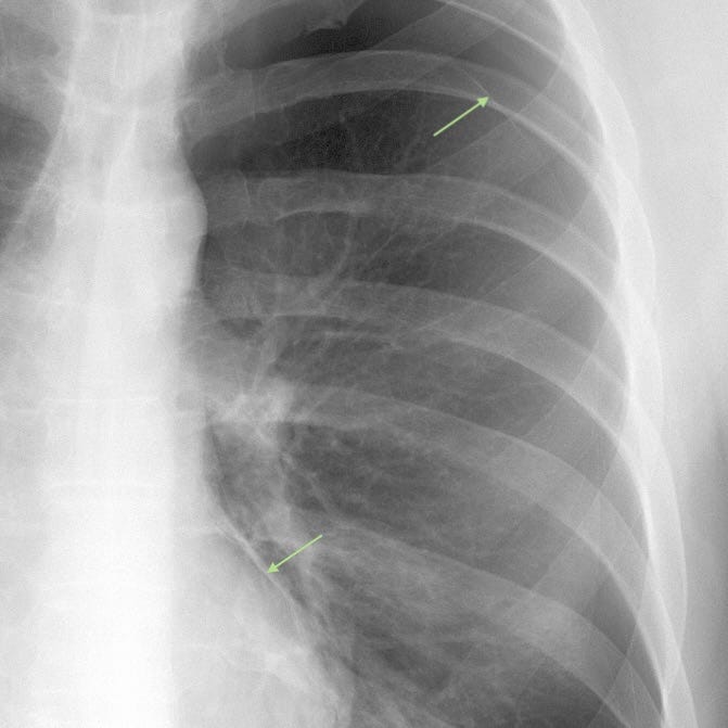 Pneumothorax - RadNotes