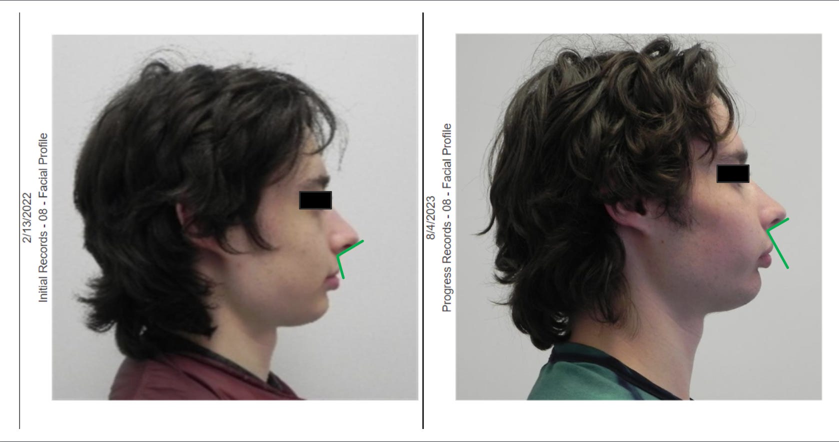Dr. Newaz's Talk on Bone-Anchored Expansion - Part 1