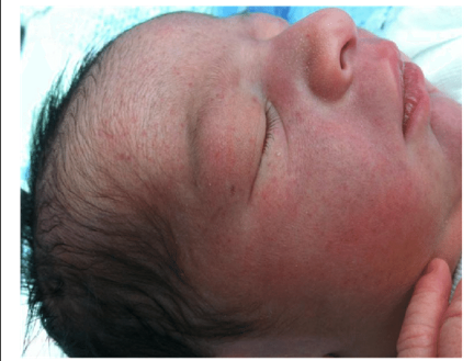 Pediatric Pearls. Infant's Skin: More Color Variations