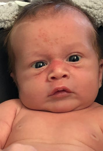 Pediatric Pearls. Infant's Skin: Milia and More