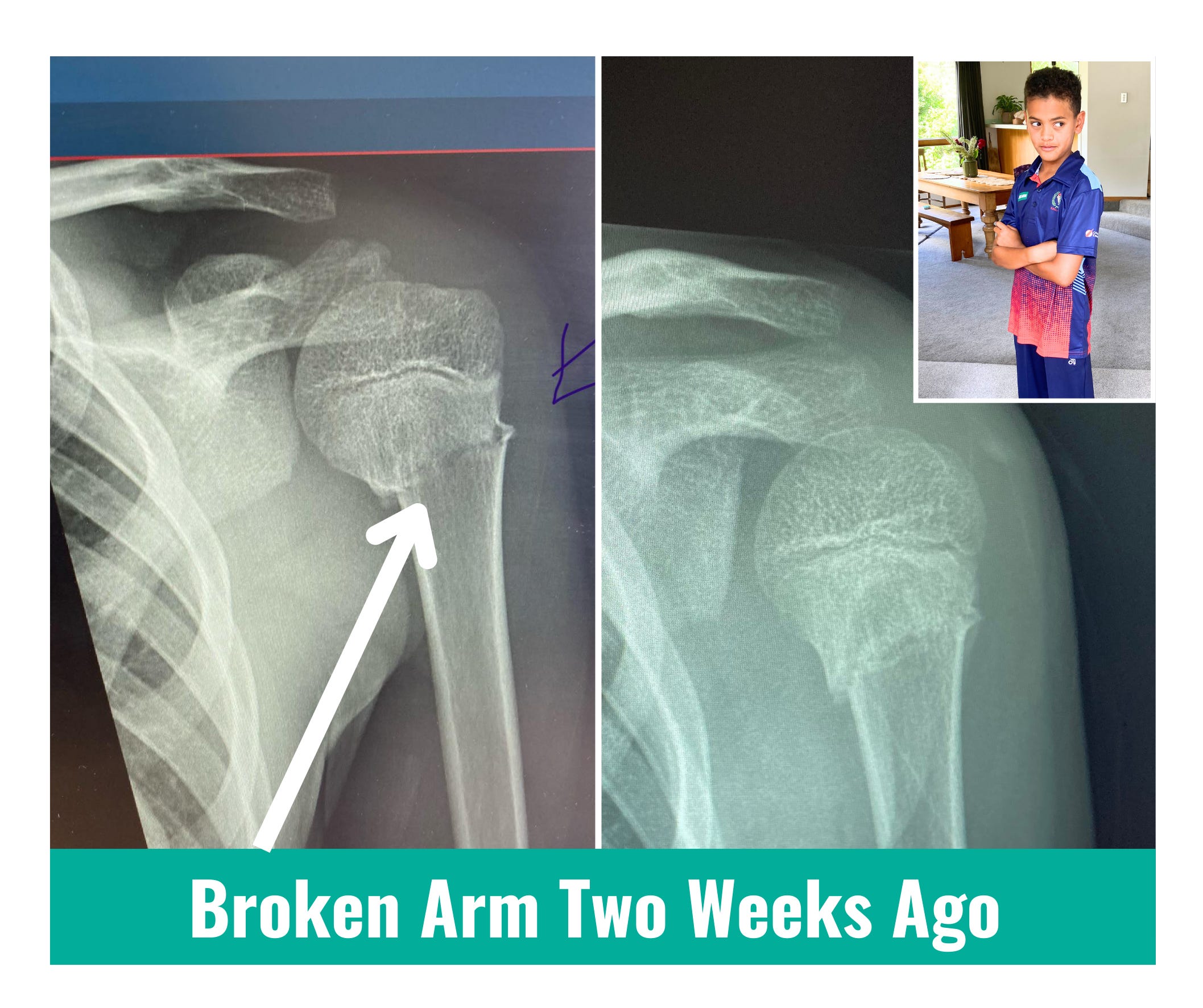 My son fell and snapped his arm two weeks ago.