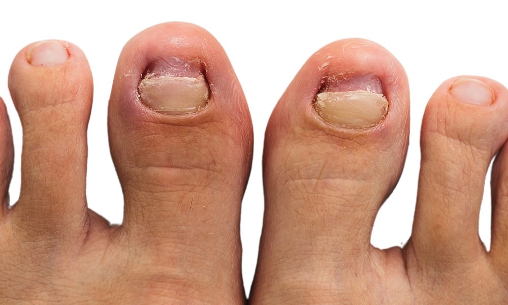Ingrown Toenails - Practical Podiatry