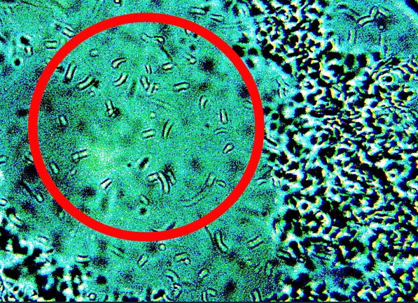 Extensive (CDB) Hydrogel Filament Growth In C19 Vaccinated and ...