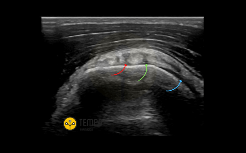 Tendón subescapular - Aprende a valorarlo