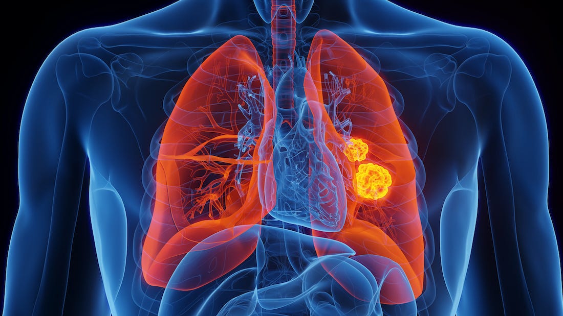 Lung Cancer - MEDILOQUY BLOG
