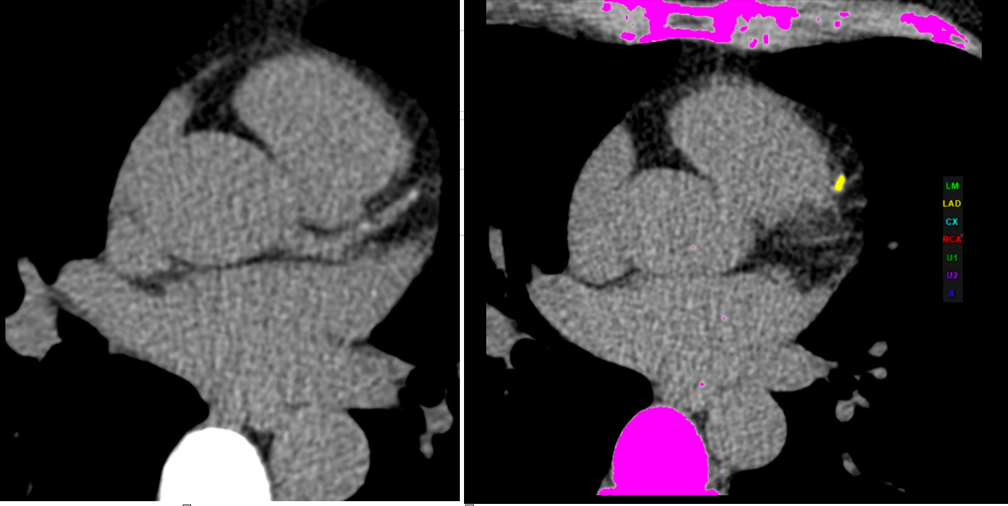 The Skeptical Cardiologist's Guide To The Coronary Artery Calcium Scan