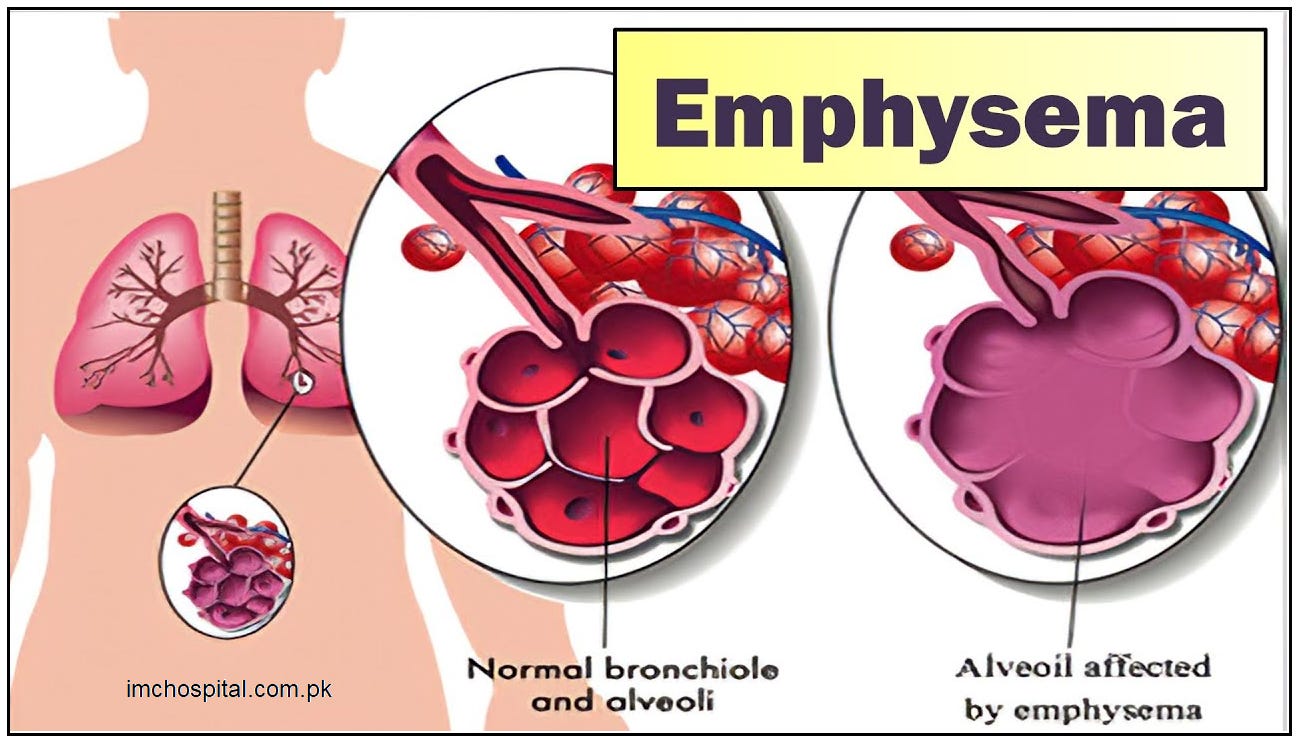 EMPHYSEMA - by Len Kinder - Ailments & Natural Remedies