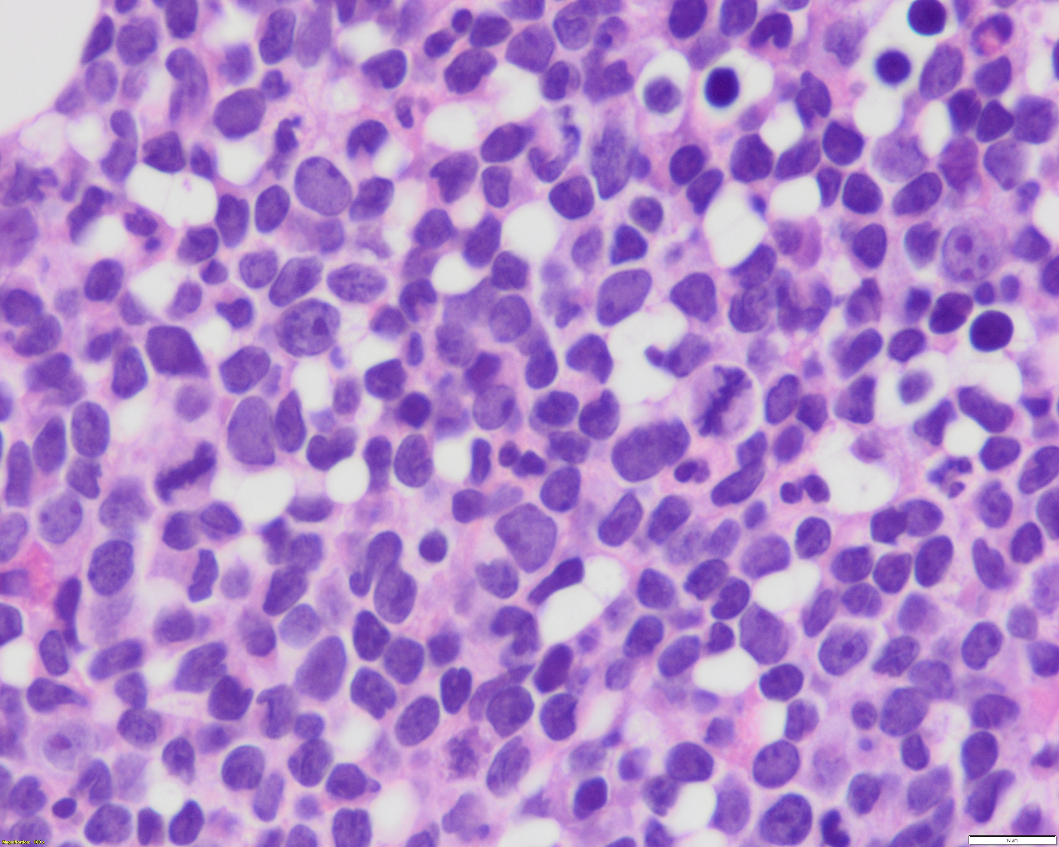 BCR::ABL1+ B-ALL vs de novo presentation of (B-lymphoid) blast phase of ...