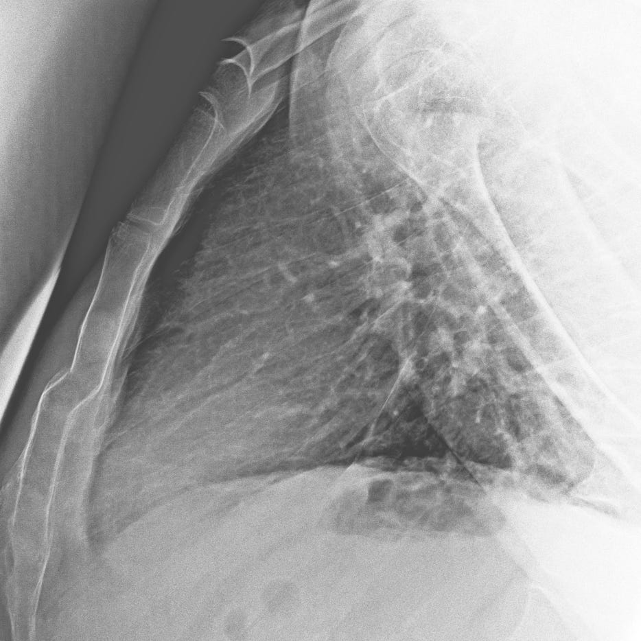 Chest wall injuries - by Alexander Baxter - RadNotes