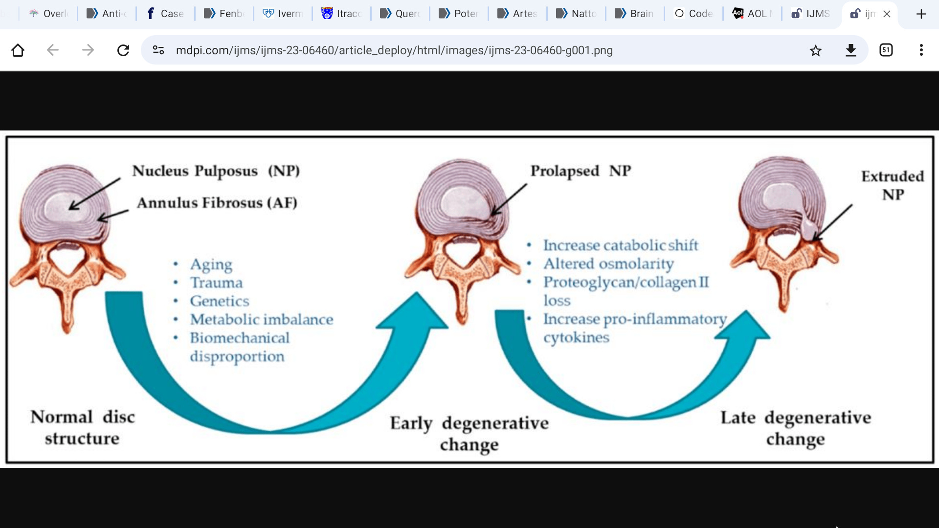 Recent Advances in Managing Spinal Intervertebral Discs Degeneration