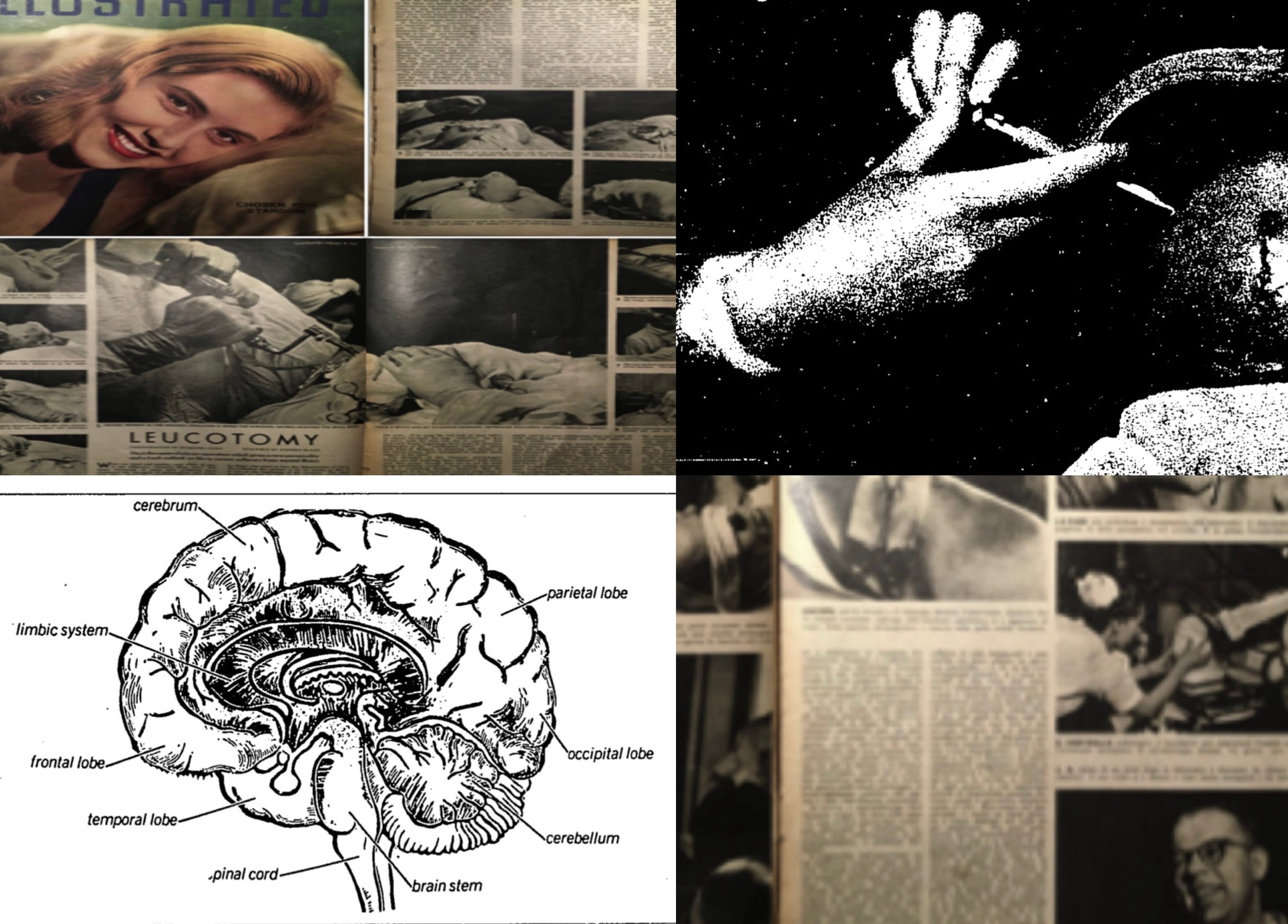 Psychosurgery, a Predecessor to ‘Gender-Affirming Care’