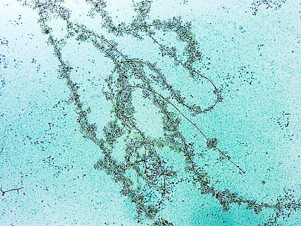 Extensive (CDB) Hydrogel Filament Growth In C19 Vaccinated and ...