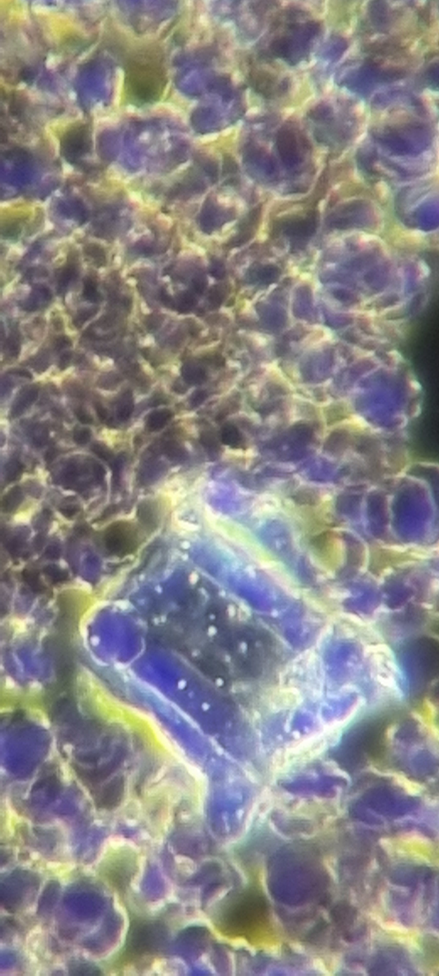 Exploding gel bubbles and WBC's, Glaucoma meds, bot breath and sundry.