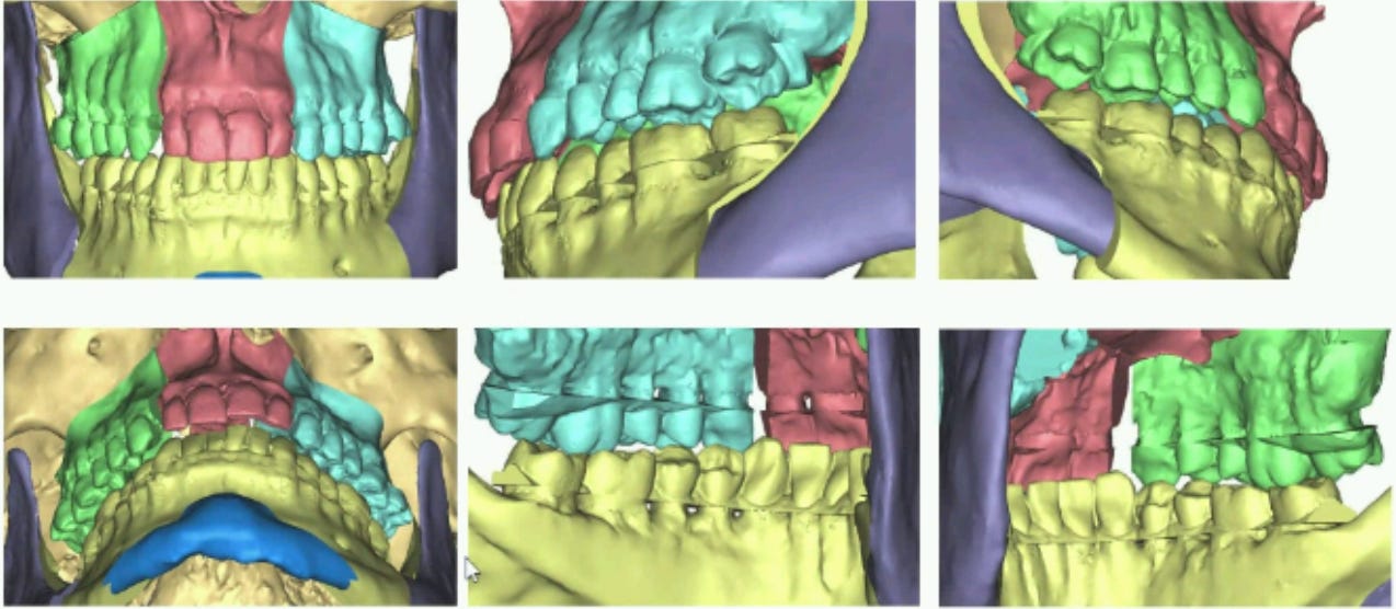 7.4 Simplifying Jaw Surgery with MARPE - by Ronald Ead