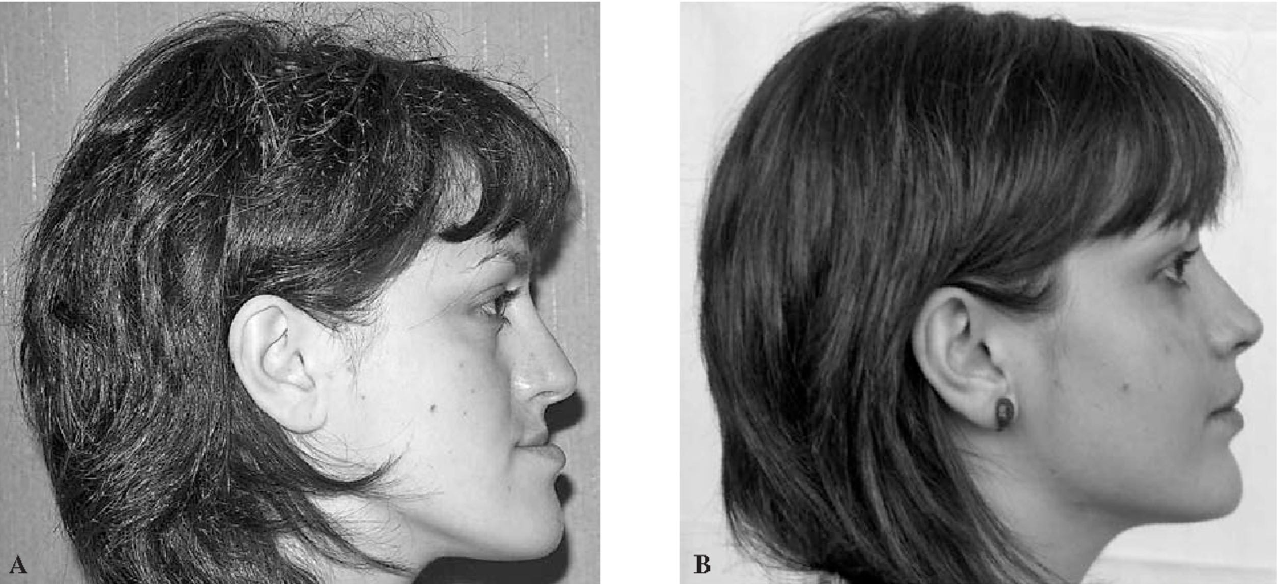 5.7 MARPE Vertical Excess Problems