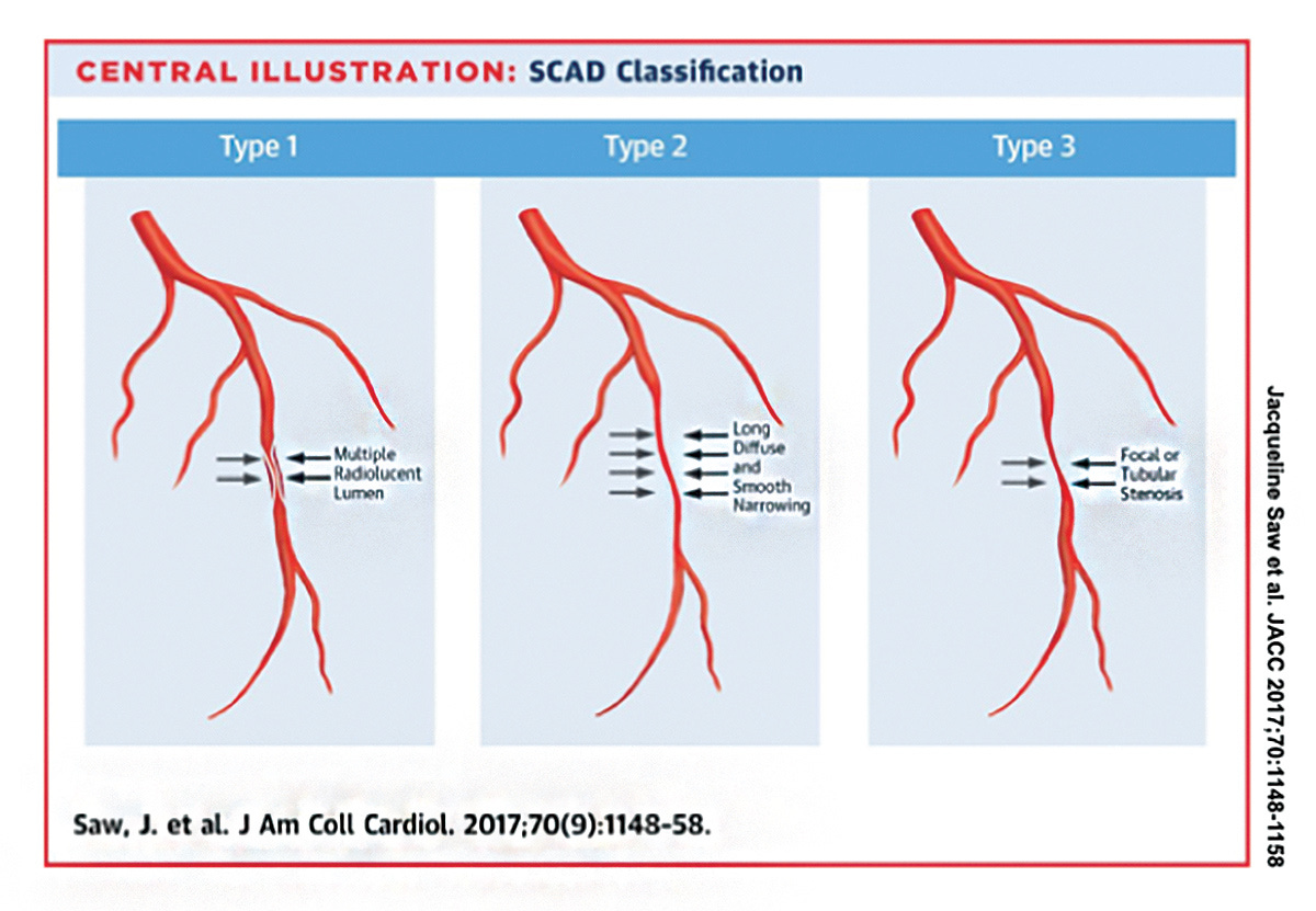 Dissecção Espontânea de Coronária