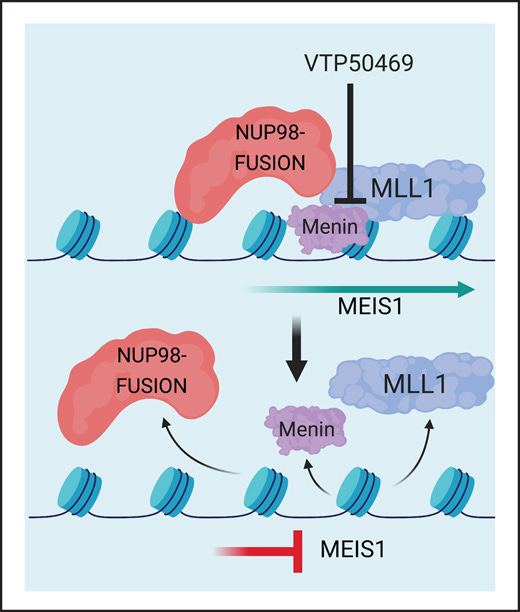 Acute myeloid leukemia with NUP98 rearrangement
