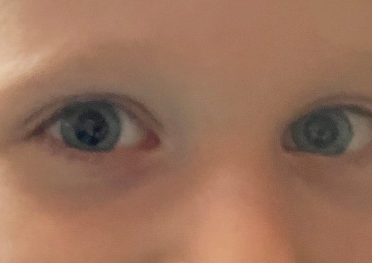 Pediatric Pearls: Infant's Eye Part 2 - Color, Discharge and Red Reflexes