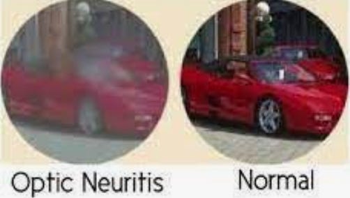 O is for Optic Neuritis - by Jane Gould