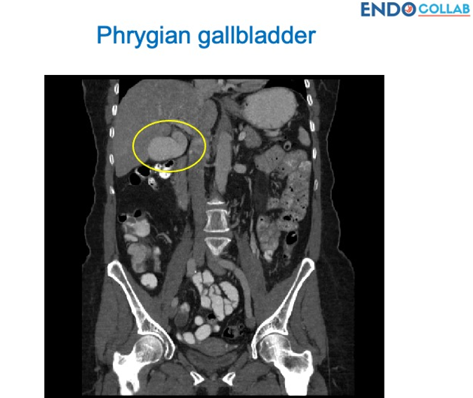 What is a Phrygian (Cap) Gallbladder? - by EndoCollab