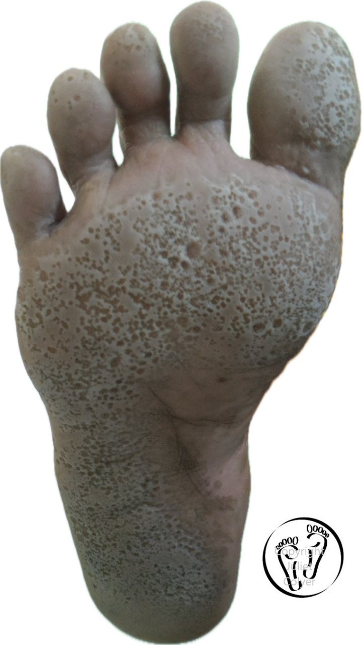 All About Stinky Feet - Practical Podiatry