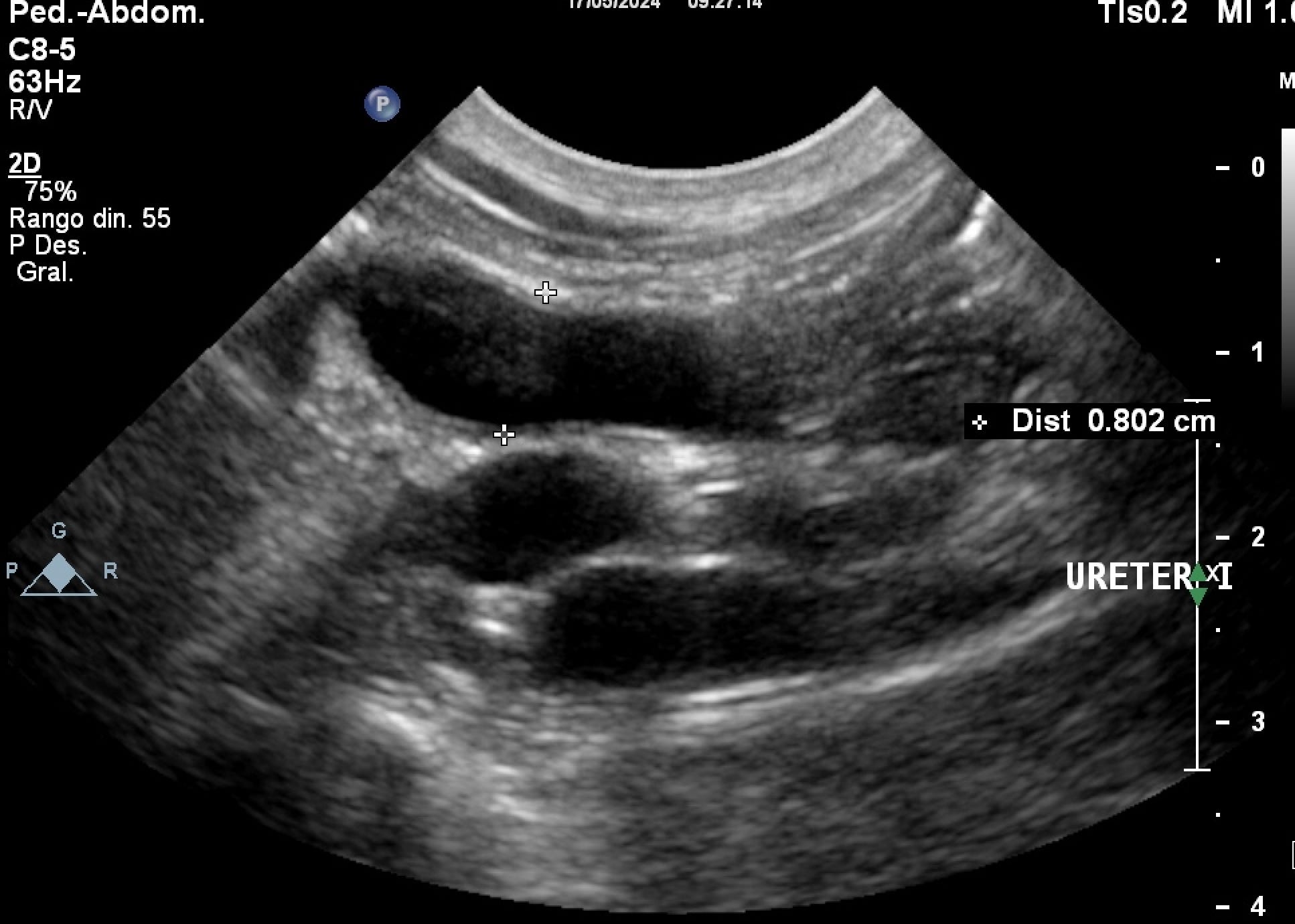 Uréter ectópico y remanente paramesonéfrico vaginal en una perra (I)