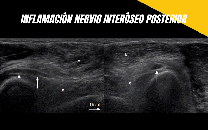 Nervio interóseo posterior - by Tempo Formación