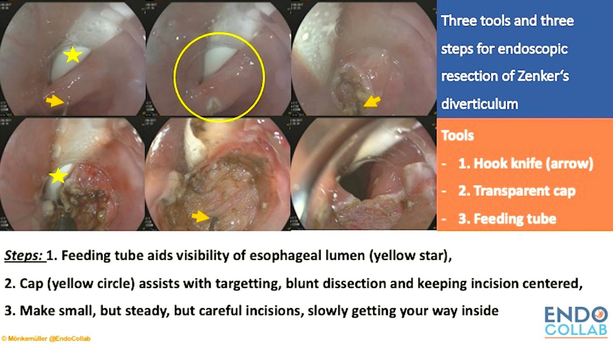 Zenker’s Diverticulum