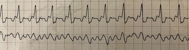 “Sinus Tachycardia” at 150 Beats Per Minute