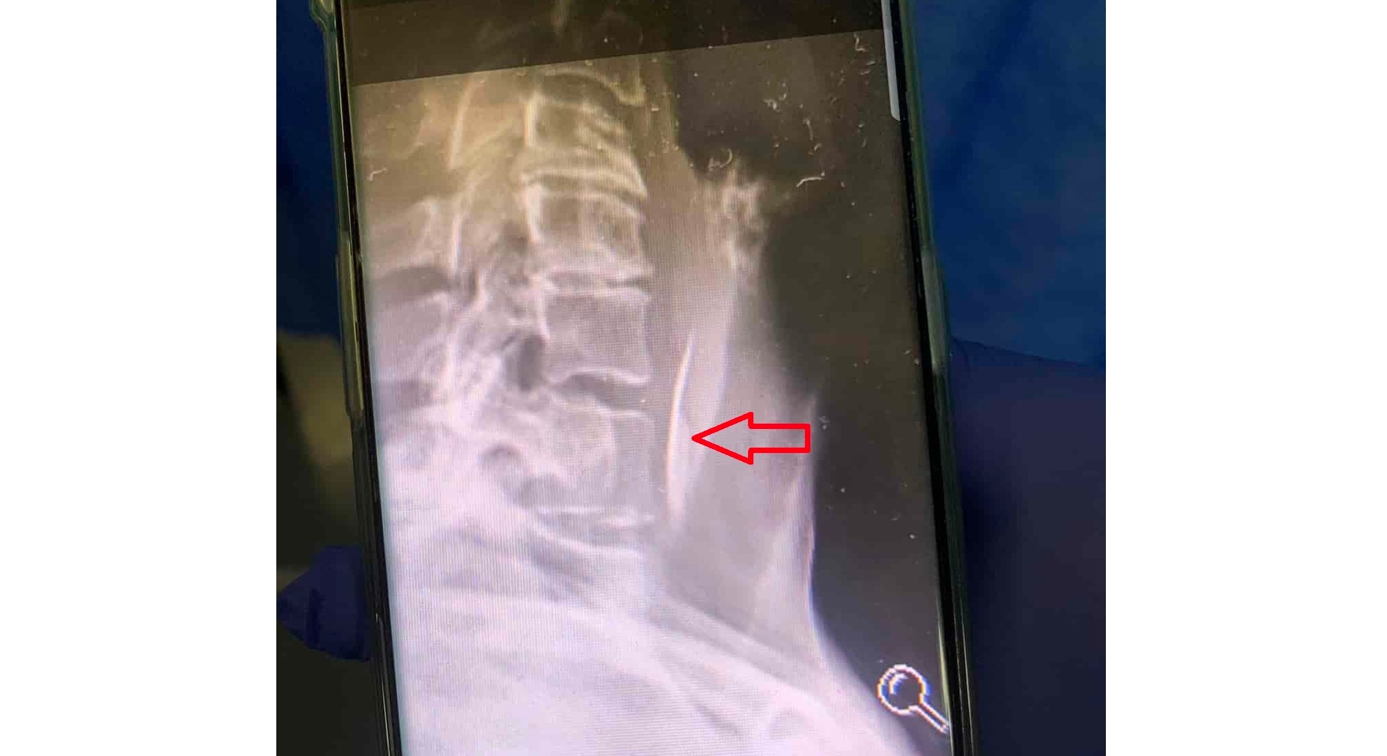 152 | I Swallowed a Big Sharp Thing! | WGS Solves a Listeria Outbreak