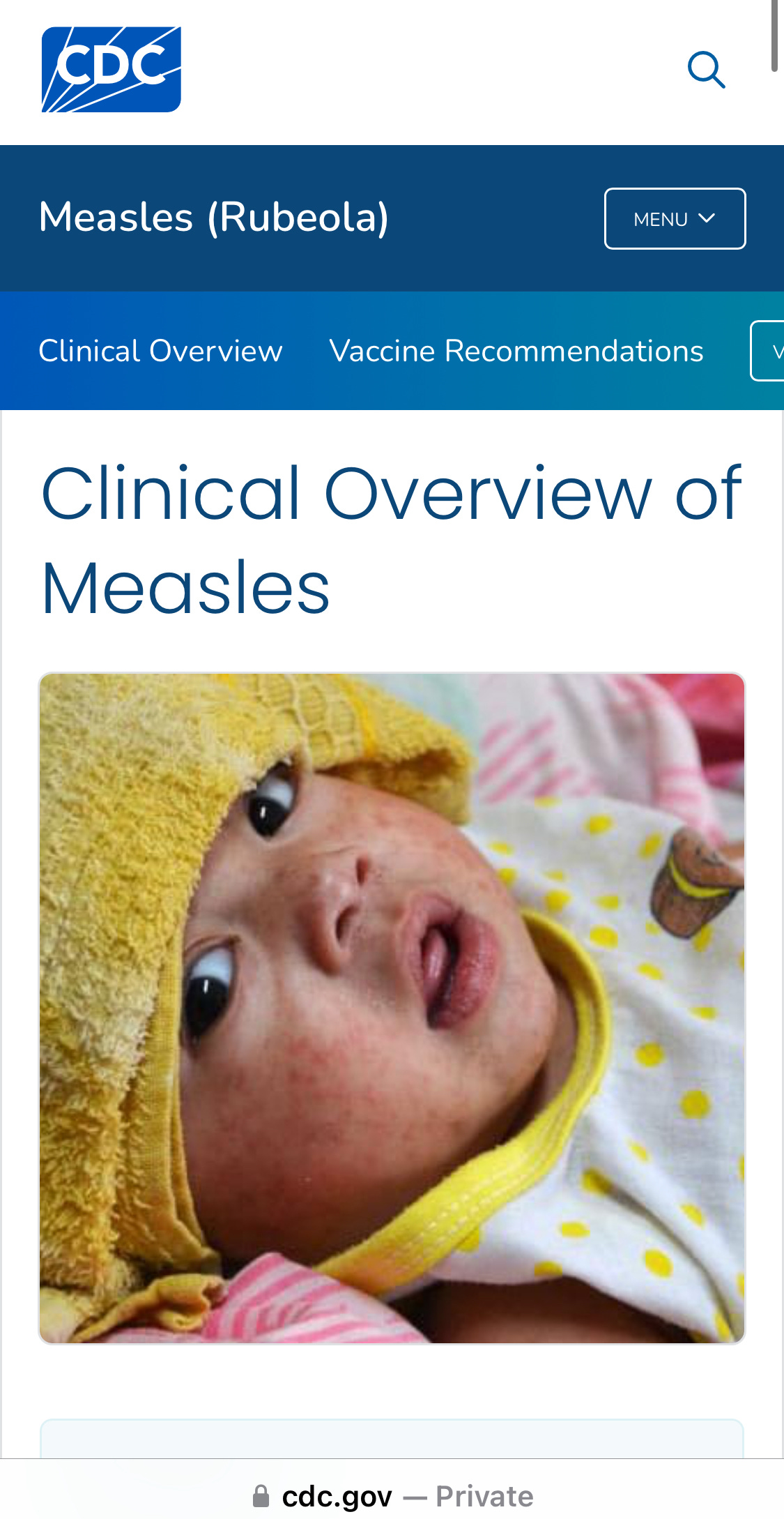 Measles, Measles Parties, the Measles Shot, the Measles “Death”, and ...