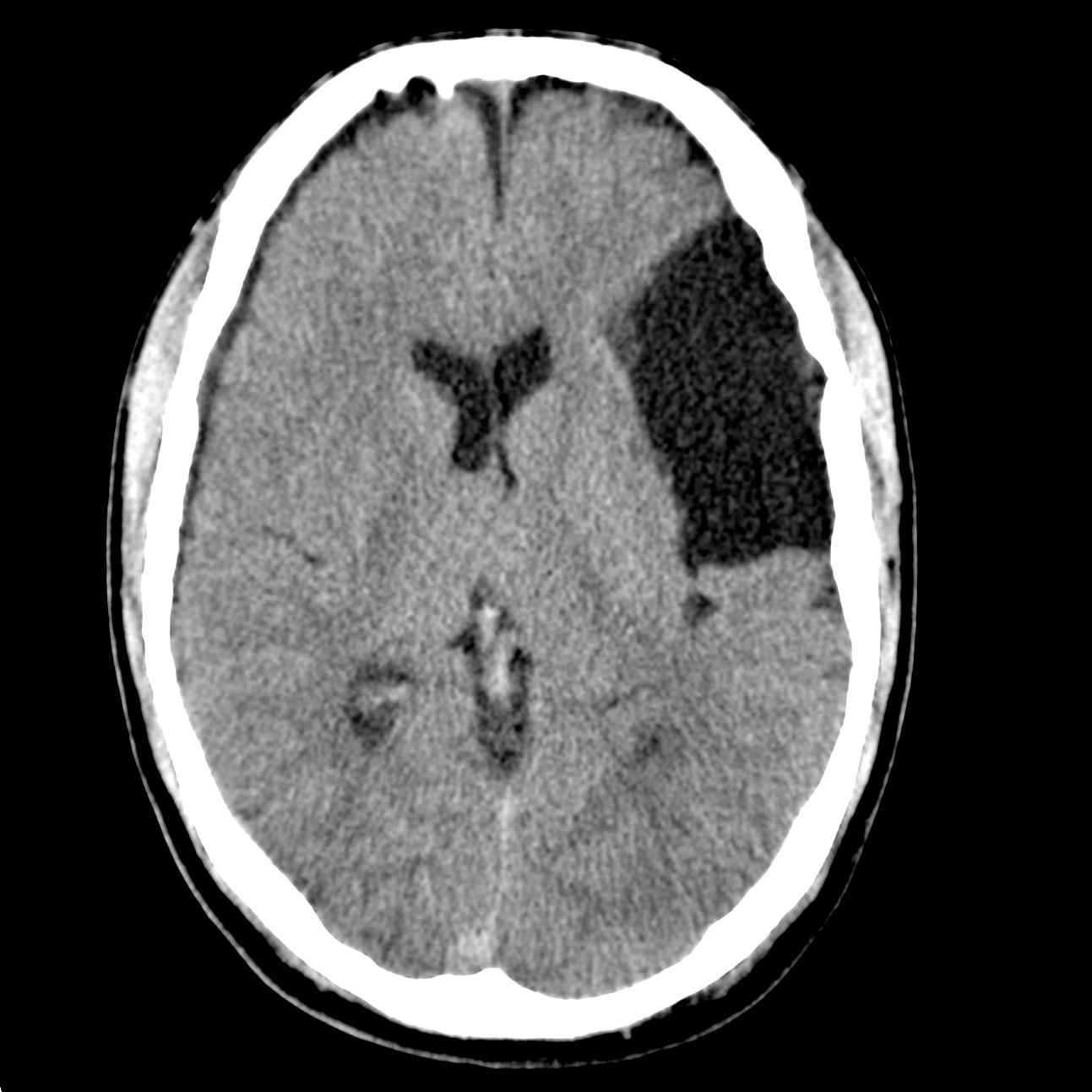 Head CT incidental findings - by Alexander Baxter